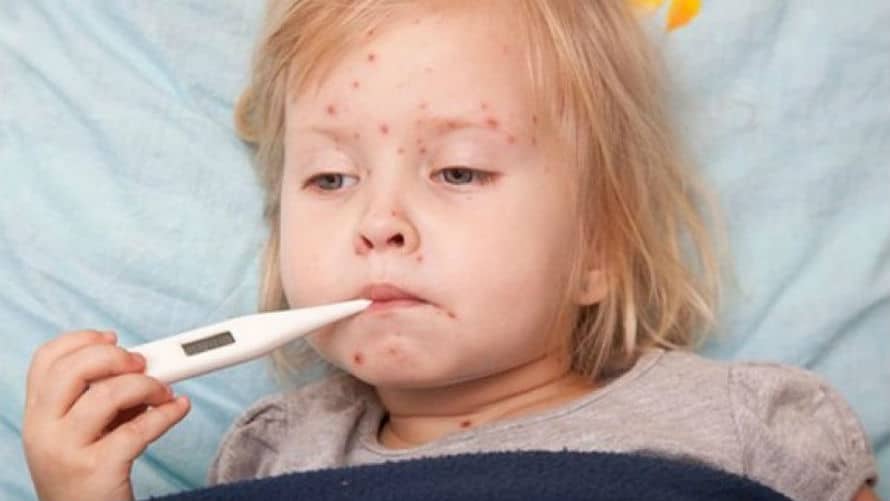 Ospice (morbilli) - uzroci, simptomi i liječenje - MaminSvijet.hr