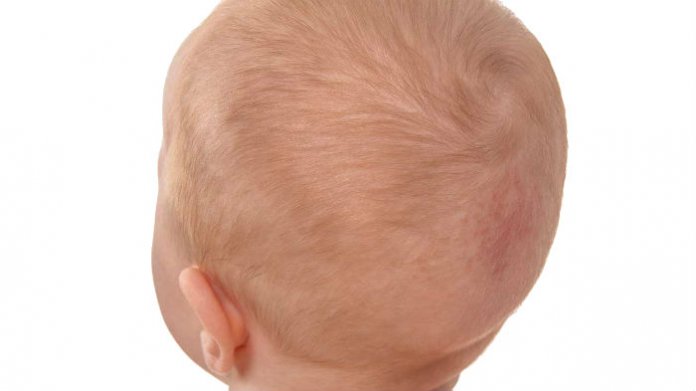 Rodin ugriz - što je, zašto se pojavljuje i treba li ga ukloniti ...