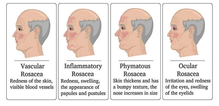 Rosacea (rozaceja) - zašto nastaje i kako se liječi? - MaminSvijet.hr