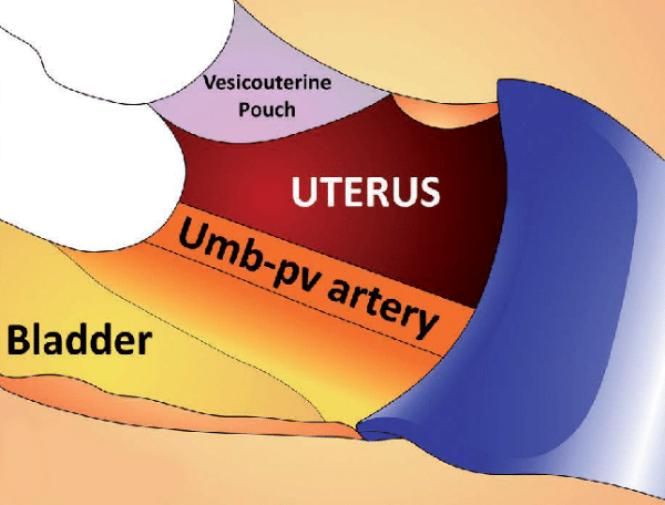 Francuski carski rez - što je, kako se izvodi i koliko traje oporavak ...